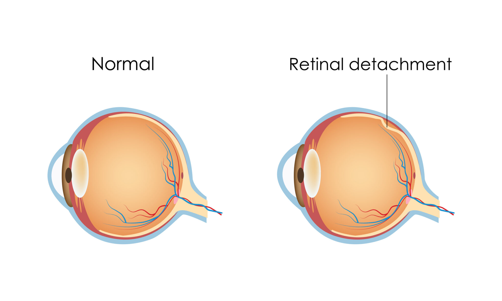 Retinal Detachment and Treatment Options - Opticare Health